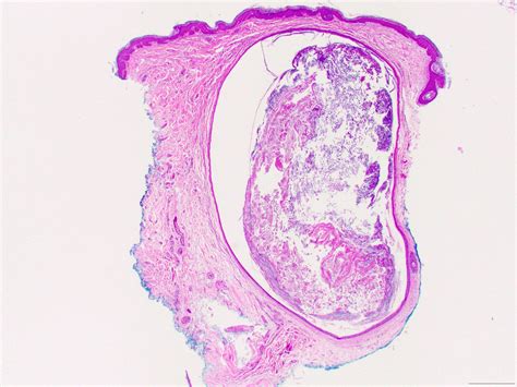 Epidermal Inclusion Cyst Labia