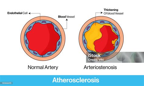 Ilustrasi Penyumbatan Pembuluh Darah Pada Aterosklerosis Ilustrasi Stok