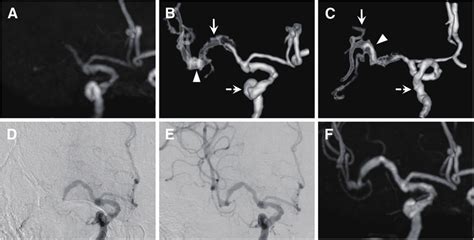 Images Obtained In Case 2 It Was Possible To Confirm Occlusion In The Download Scientific