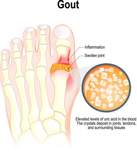 Gout Arthritis Infographic Royalty Free Vector Image