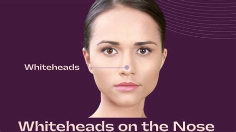 Whiteheads On The Nose Causes Treatments Prevention