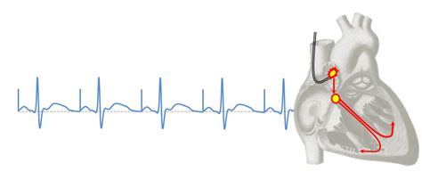 Single And Dual Chamber Pacing Modes Deranged Physiology
