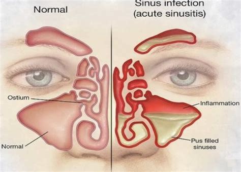 코속 염증 코끝 염증 만성 축농증 급성 축농증 증상 원인 코 염증 치료 관련 정보 건강한 삶을 리뷰하는 Heeee