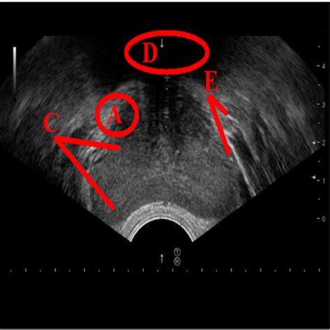 Challenges In Prostate Segmentation Caused By Different Factors A Download Scientific