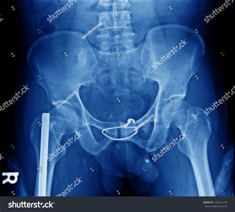 X Ray Fractures Bone Stock Photo 145412110 Shutterstock