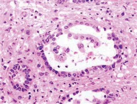 Cholangiocellular Hepatocarcinoma Annals Of Hepatology Cholangiocellular Hepatocarcinoma Annals Of Hepatology