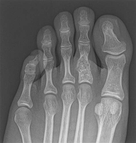 Lucent Lytic Bone Lesion Differential Diagnosis Mnemonic Pacs