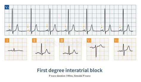 First Degree Interatrial Block Stock Illustration Illustration Of