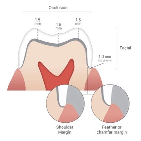 Pfm Crown Prep Dimensions