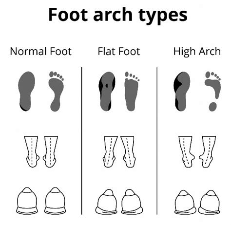 Foot Arch Types Foot And Leg Centre