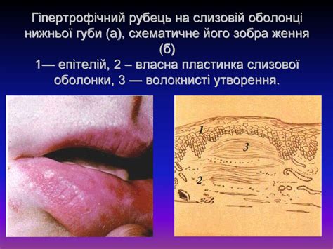 Слизова оболонка порожнини рота Будова функції Патологічні процеси що виникають на слизовій