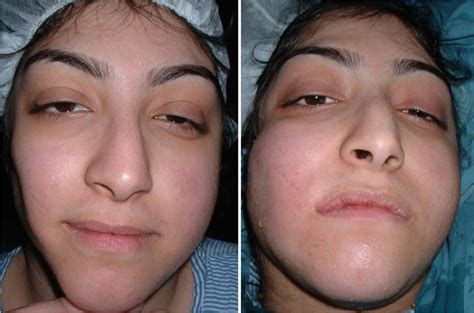 Left Preoperative Photograph Of A Patient With Right Hemifacial