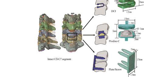 Finite Element Model Of Cervical Segments And Implants Download