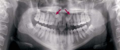 Exposure And Bracketing Of Impacted Teeth