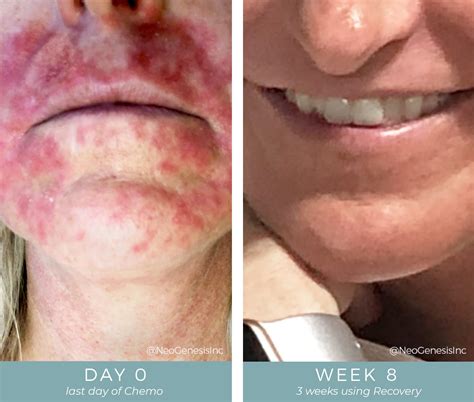 Topical Chemotherapy Side Effects Using Fluorouracil Fu5