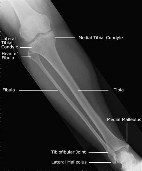 Tib Fib Anatomy Diagnostic Imaging Medical Radiography Medical Anatomy