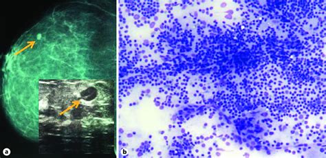 Intramammary Lymph Node Ultrasound Wxcqrb