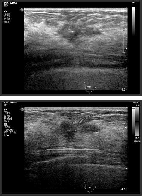 Ultrasonographic Images Showing Four Malignant Characteristics The Download Scientific Diagram