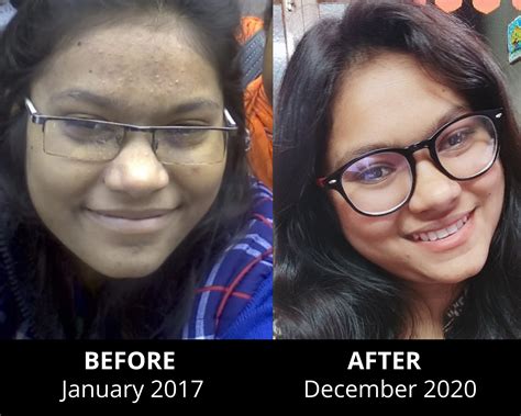 Nitika Reverses Her 7 Year Old Acne In 1 Month Satvic Movement