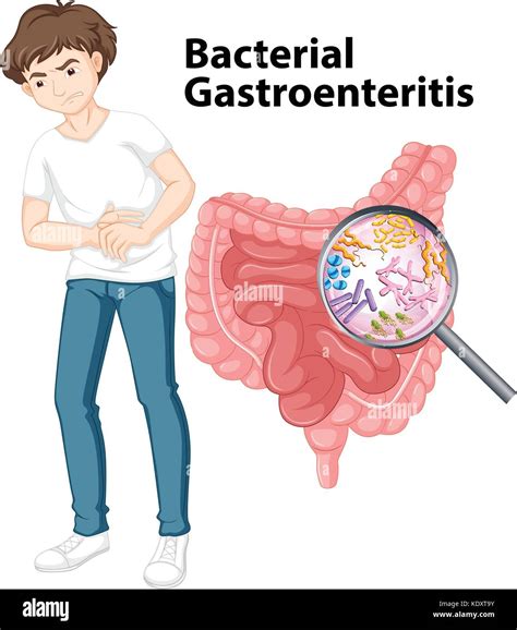Viral Gastroenteritis