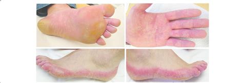 Phenotypic Appearance Of The 36 Year Old Male Proband Affected By Download Scientific Diagram