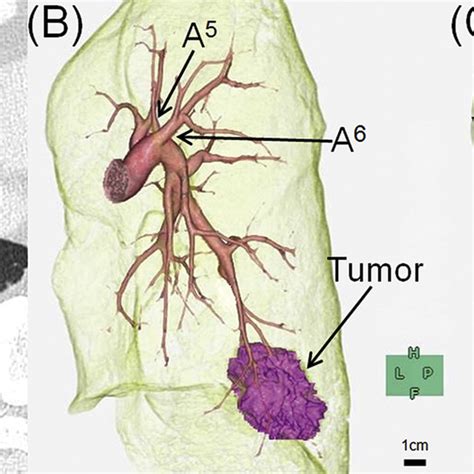 Pdf Thoracoscopic Right Basilar Segmentectomy After Right Upper Lobectomy