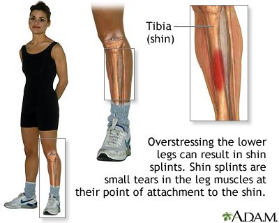 Shin Splints Medlineplus Medical Encyclopedia Image