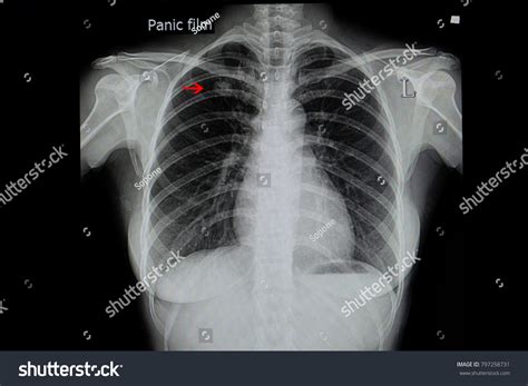Chest Xray Film Patient Lung Nodule库存照片797258731 Shutterstock