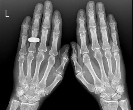 Erosive Osteoarthritis Radiology Case Radiopaedia Org