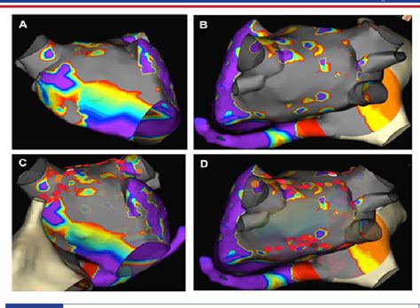Figure 2 From Subxiphoid Hybrid Approach For Epicardialendocardial