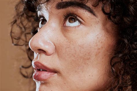 Hyperpigmentation Skin Yhvh Medical Clinic