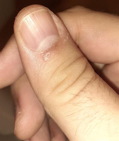 Is This Subungual Melanoma Rmelanoma