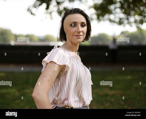Adele Bellis 24 Who Was Scarred For Life In An Acid Attack