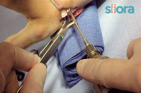 Open Reduction And Internal Fixation A Detailed Guide Siora Surgicals Pvt Ltd