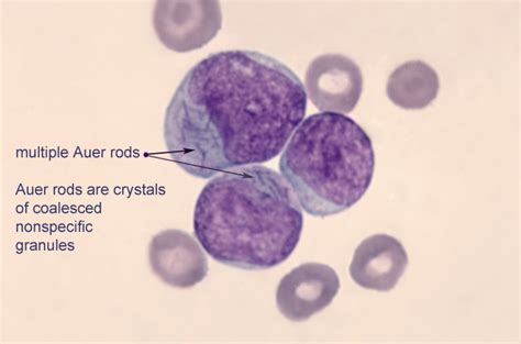 Auer Rods In Acute Myeloblastic Leukemia With Differentiation Eccles