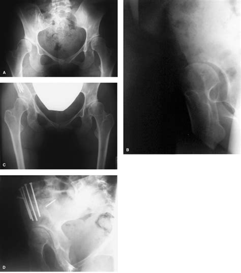 Mcp Metacarpophalangeal Dislocation Teachme Orthopedics