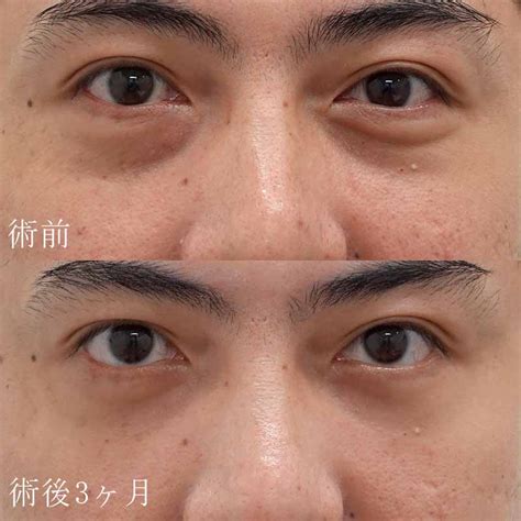 裏ハムラ法の症例写真ビフォーアフター 執刀医塚原 健汰 美容整形なら水の森美容クリニック