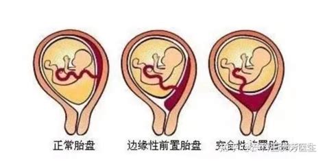胎盘低或前置要一直卧床吗?不怕,注意这几点! 知乎 胎盘低或前置要一直卧床吗?不怕,注意这几点! 知乎