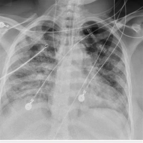 Chest Radiography Cxr On Hospital Day Five Showed Diffuse