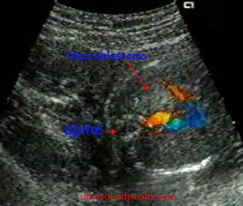 Neuroblastoma Ultrasound