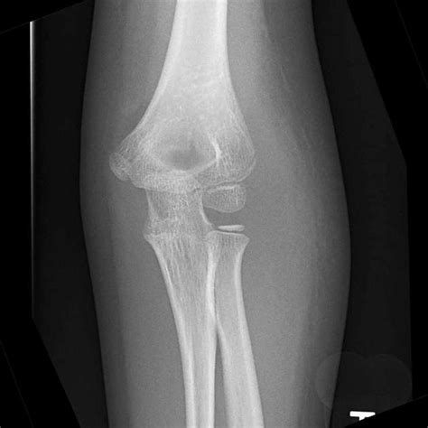 Lateral Condyle Fracture Paediatric