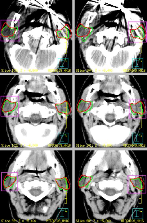 Figure B3 Middle Two Columns Show The Segmentation Of Parotid Glands