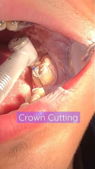 Tooth Cutting Proceduretooth Cutting For Fixed Crowningfixed Crowning