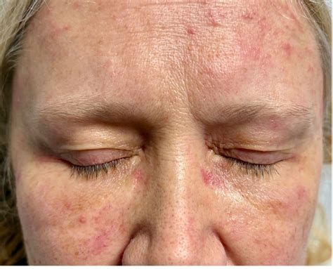 Mild Heliotrope Rash