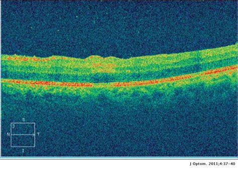Selective Inner Retinal Layer Involvement In Early Syphilitic Retinitis