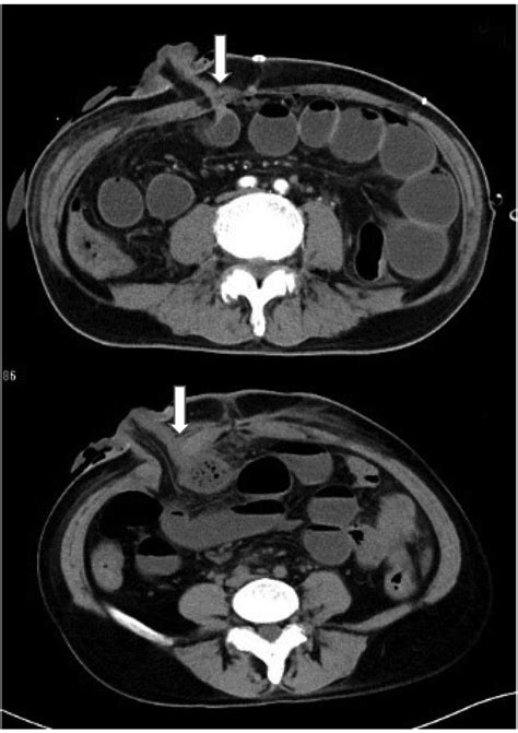 Defunctioning Ileostomy Is A Key Risk Factor For Small Bowel