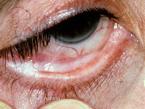 Ocular Cicatricial Pemphigoid