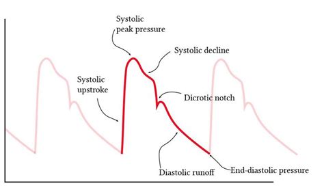 Normal Arterial Line Waveforms Deranged Physiology Arterial Line