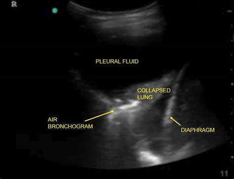 2 Lung Ultrasound Pre Reading For Fcus Course Intensive Care Network