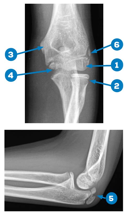 Figures 1a And 1b Normal X Rays 13 Year Old Male 1 Capitellum 2